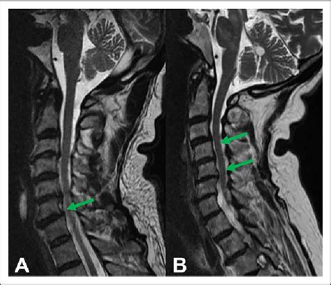 Retrolisthesis Cervical C3 C4
