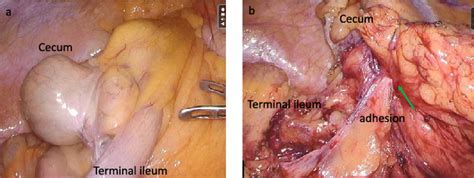 Intraoperative Findings A Surgical Findings Revealing An