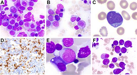Morphologic Characteristics Of Myelodysplastic Syndromes Clinics In