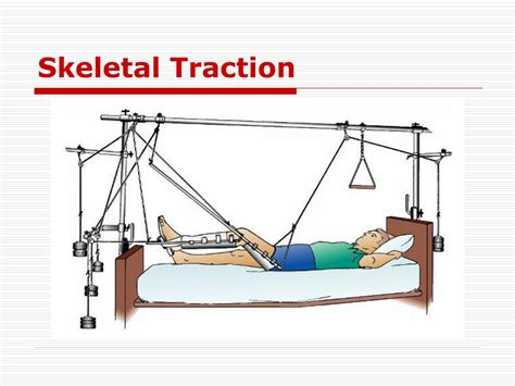 Skeletal Traction Pin Insertion Sites At Ashley Smalley Blog