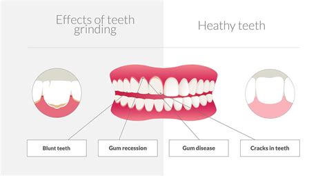 How To Test For Teeth Grinding At Anna Octoman Blog
