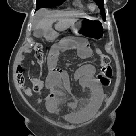 Dilated Small Bowel Loops With A Transition Zone Bowel Thickening And Download Scientific