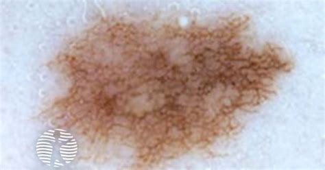 Reticular Pattern Dermoscopy Image Reticular Pattern Dermoscopy Image