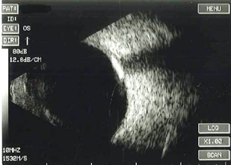 Sclerochoroidal Calcification Leads To Diagnosis Of Primary Parathyroid Cancer Published In