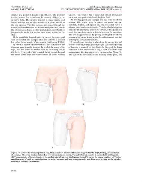 Acs0620 Lower Extremity Amputation For Ischemia Pdf