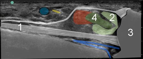 Foot And Ankle Peroneus Brevis Split Tear 2 Image Sonosite Institute For Point Of Care Ultrasound