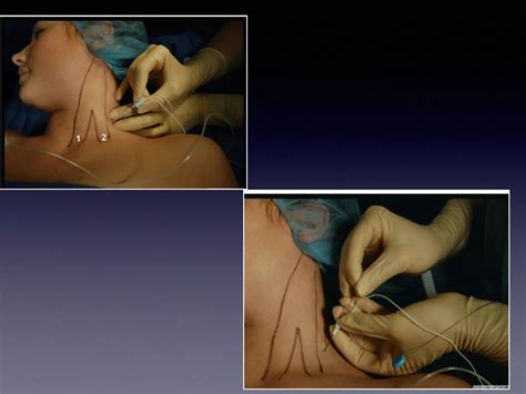 Shoulder Block Tutorial 2014 Ppt Free Download