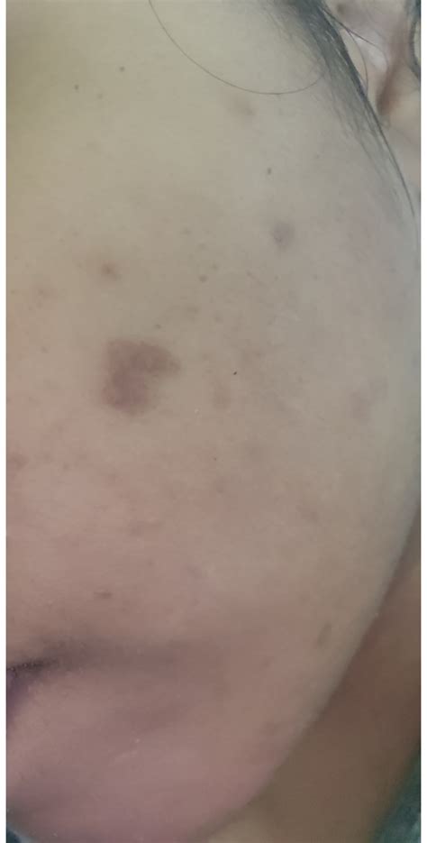 Pimple Scar R Skincare Addiction