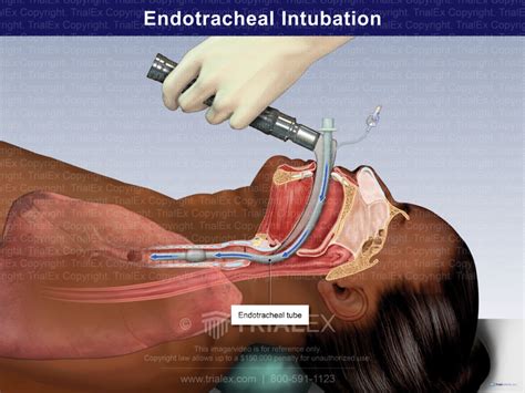 Endotracheal Intubation