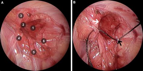 Anatomy Of Pediatric Male Inguinal Hernia A1 Internal Ring Of Indirect
