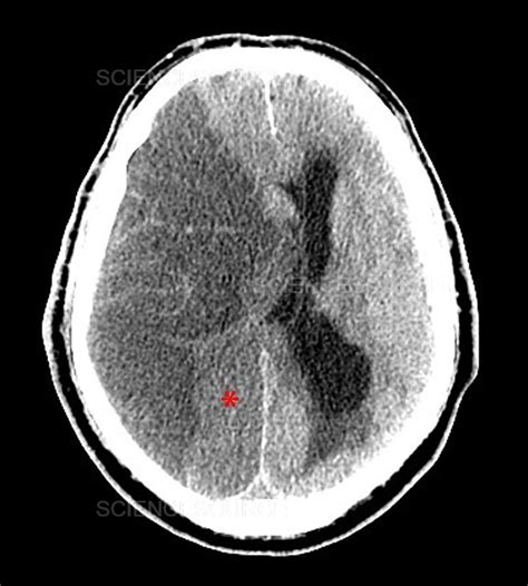 Large Stroke CT Scan Stock Image Science Source Images