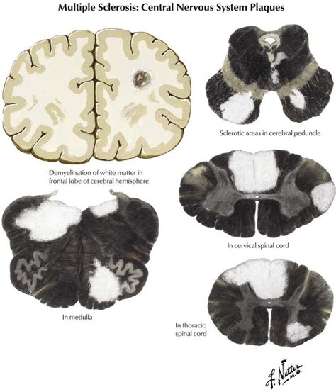 Multiple Sclerosis Clinical Gate