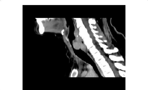 Neck Ct Scan Sagittal View Showed Submucosal Subglottic Mass Narrowing Download Scientific
