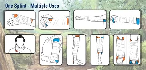 36 Rolled Sam Splint Immobilise Broken Bones Sprain Injuries Leg Arm Shin Splint Roll Buy Sam