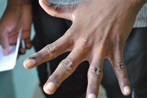 Scabies Rash Hands