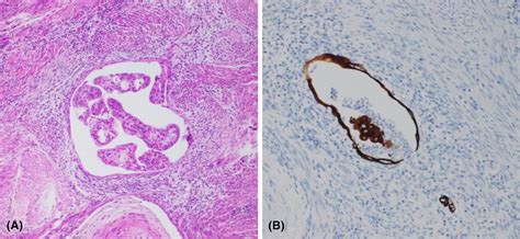 Practical Guidance For Assessing And Reporting Lymphovascular Space Invasion Lvsi In