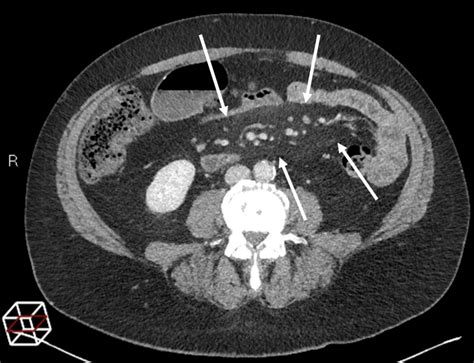 Mesenteric Panniculitis A Clinical Conundrum Pmc