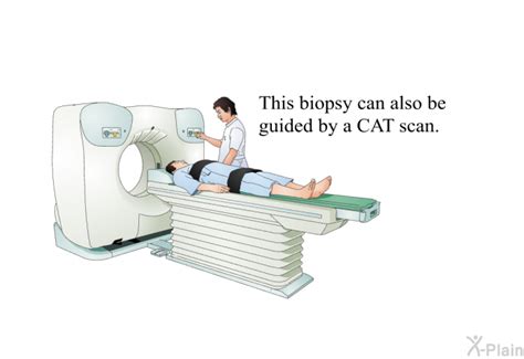 Ct Scan Guided Biopsy Of A Lung Or Other Chest Area Lesion