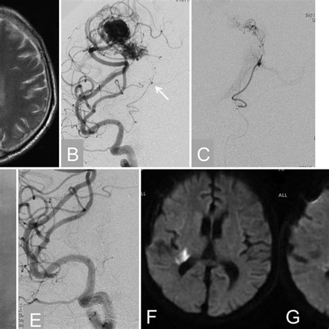Schematic Illustration Of A Lateral Angiogram Showing The Angiographic