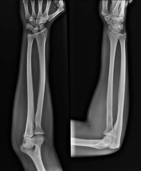 Forearm Xray Labeled At Neida Tracy Blog