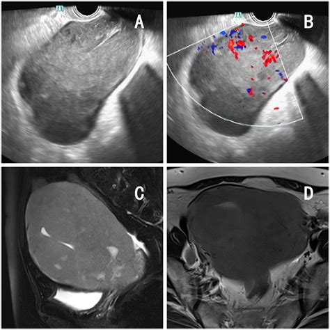 Imaging Findings Of The Patient A B Pelvic Ultrasound A 13 4 × 9 4 Download Scientific