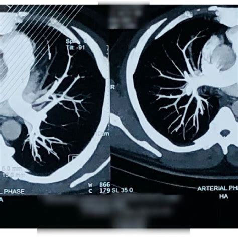 Follow Up Ctpa Showing Resolution Of Previous Contrast Filling Defect Download Scientific