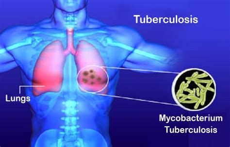 Signs Symptoms Tuberculosis Choose Your Life Style