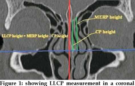 Figure 1 From Assessment Of Olfactory Fossa Depth Based On Keros Classification Using