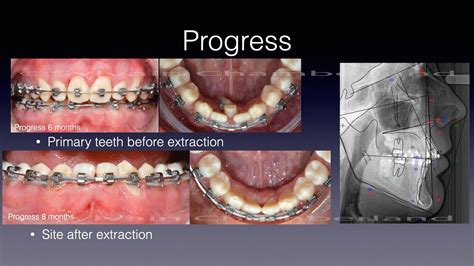Extraction Of A Mandibular Incisor Dr Sylvain Chamberland Orthodontist