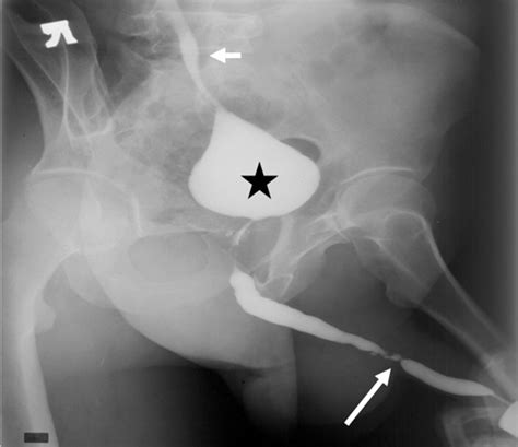 Imaging Of The Adult Male Urethra Penile Prostheses And Artificial