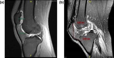 Patellofemoral Pain Syndrome Review Sports Medicine Review