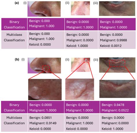 Deep Learning Approaches For The Classification Of Keloid Images In The