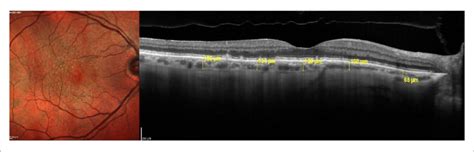 Representation Of The Optical Coherence Tomography Scan Showing Download Scientific Diagram