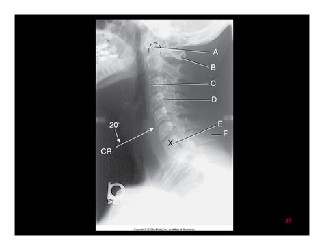 Lateral C Spine Diagram Quizlet