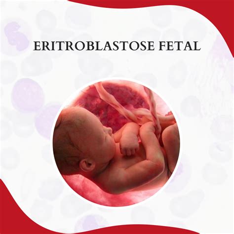 Eritroblastose Fetal