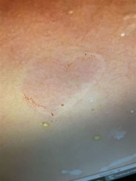 Rectal Polyp Today ️ Veysel Tahan Md Agaf Facg Fasge Facp Fesbgh