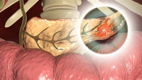 ¿qué Es El Cáncer De Páncreas Principales Causas Y Síntomas De La