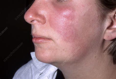 Erysipelas Stock Image C0595104 Science Photo Library