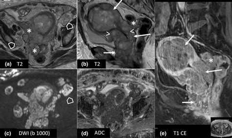High Grade Endometrial Stromal Sarcoma Hg Ess In A 78 Year Old Woman Download Scientific
