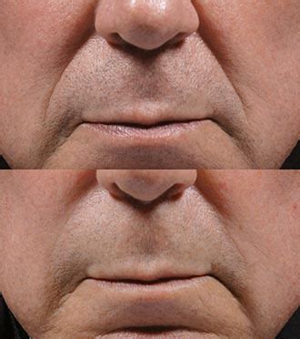 Bellafill Cosmetic Dermal Filler In Gainesville Fl