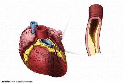 Infarto Do Miocárdio Sinais Sintomas E Doenças Abcmed