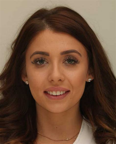 Braces For Buck Teeth Before And After At Eleanor Wilkerson Blog