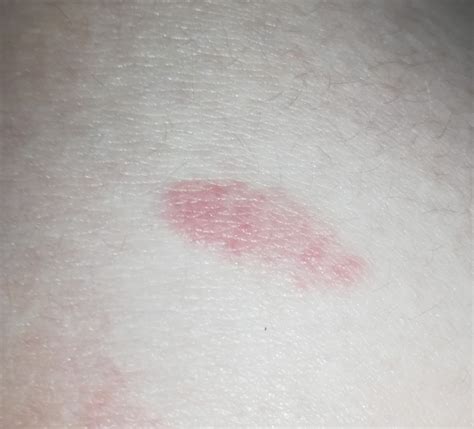 Небольшое красное пятно Вопрос дерматологу 03 Онлайн