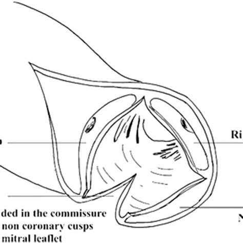 Anterior And Posterior Aortic Root Augmentation Incisions On The Left Download Scientific