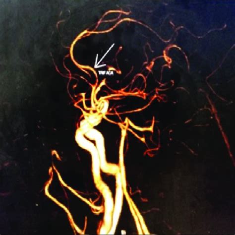 Computed Tomography Angiographic Image Of Trifurcation Of Anterior Download Scientific Diagram