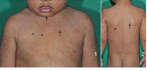 Figure 1 From Coexistence Of Juvenile Xanthogranuloma And Diffuse Plane Xanthoma In 22 Month Old