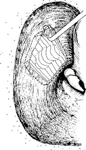 Basic Mastoidectomy Techniques Ento Key