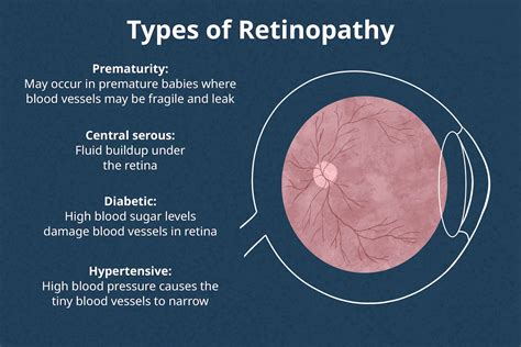 Nonproliferative Vs Proliferative Retinopathy Frontiers Genetic