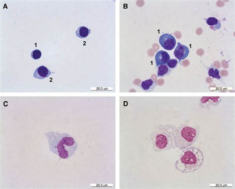 Malignant Cells In Csf