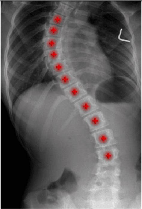 Figure 1 From A Mask Based Segmentation Algorithm For Automatic Measurement Of Cobb Angle From